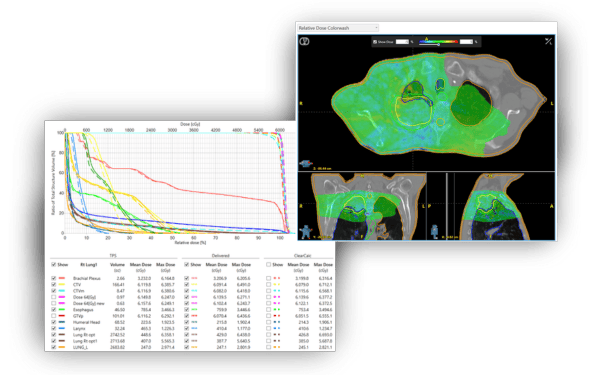 Patient Specific QA with Radformation's Robust Solutions